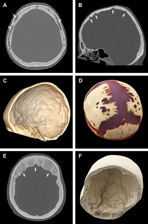 Anatomy Of The Calvaria And Skull Base Neuroimaging Clinics