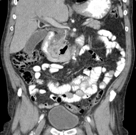 Emergency Medicine Educationcholangitis Pearls And Pitfalls