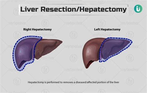 Liver Resectionhepatectomy Procedure Purpose Results Cost Price Liver Resectionhepatectomy Procedure Purpose Results Cost Price