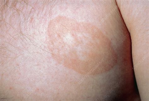 Ringworm Of The Body Tinea Corporis Pictures
