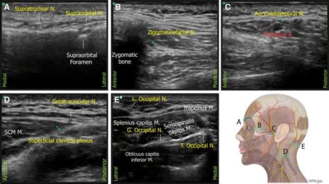 Influence Of Levobupivacaine Regional Scalp Block On Hemodyn