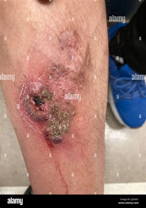 Pyoderma Gangrenosum This Disease Causes Painful Ulcers On The Skin