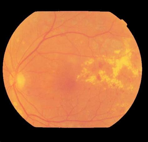 Color Contrast Enhancement A Original Color Fundus Image B Download Scientific Diagram