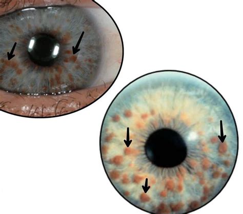 Lisch Nodules Neurofibromatosis Type 1 Clinical Presentation History