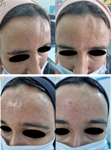 A B A Median Atrophy Of The Forehead C D A Satisfying Result And