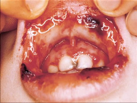 Punctate Oral Erosions Self Limited “sore”—or Something More Serious Consultant360