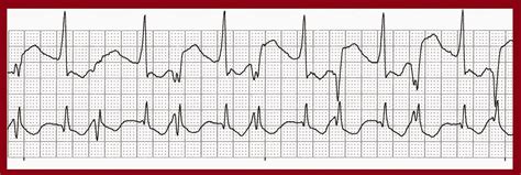 Float Nurse Practice EKG Strips