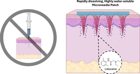 Recent Developments In Transdermal Microneedle Drug Delivery Acs