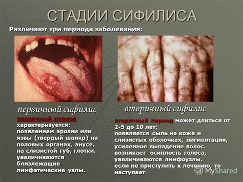 Презентация на тему И инфекции И инфекции П передаваемые П