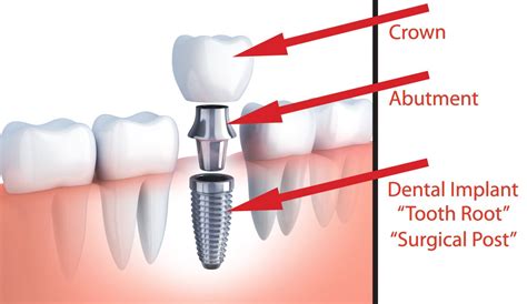 Dental Implant Abutment