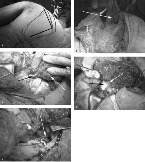 Subacromial Injection Teachme Orthopedics