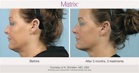 Matrix Rf Microneedling Candela Medical