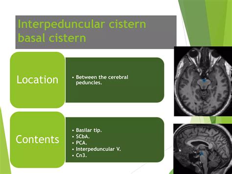 Basal Cisterns Final Ppt
