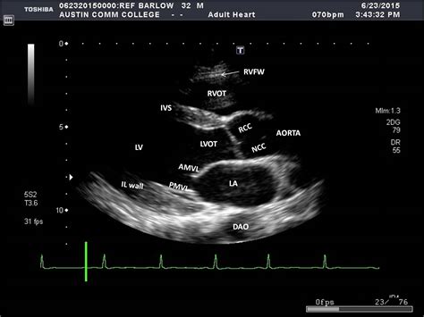 Aortic Valve Cusps Echo