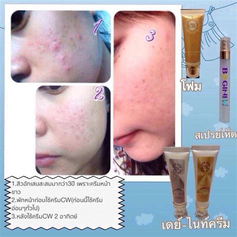 เรื่องสิวๆเราช่วยได้ สตอเบอรี่เกล็ดหิมะ By ชูใจชื่นใจ