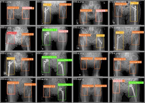 Development Of A Machine Learning Model For Bone Fracture Assessment By Maekin Namwong Medium