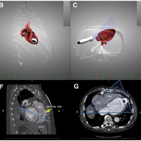 Colour Doppler And Pulsed Wave Doppler Interrogation Of The Lvad Inflow