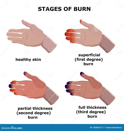 Medical Vector Illustration Burn Stages Stock Vector Illustration Of