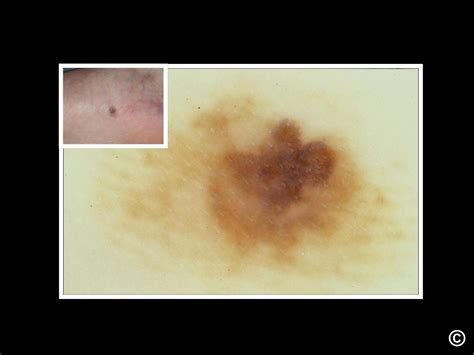 Acral Lentiginous Melanoma