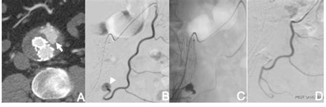 Transarterial Embolisation Of Type 2 Endoleak A Axial Ct Image Shows