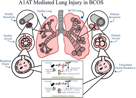 Bronchiectasis Copd Overlap Syndrome A Comprehensive Review Of Its