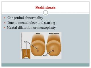 Congenital Genito Urinary Disorders Pptx