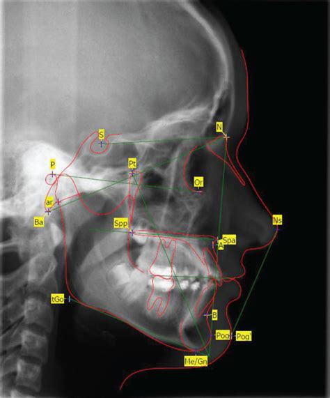 Lateral Cephalometric Radiograph With Evaluation 48 Months
