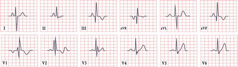 Pulmonary Embolism Ecg