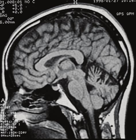 Spinocerebellar Ataxia Type Presenting With Motor Neuron 45 Off