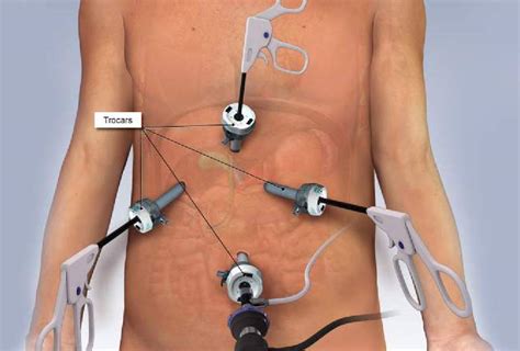 Laparoscopic Cholecystectomy In Nigdi Safe And Painless Gallbladder Surgery