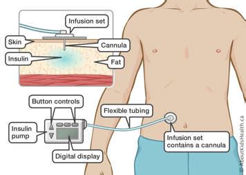 Insulin Pumps