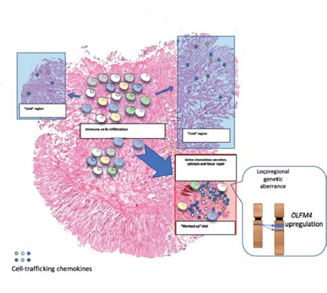Spatial Transcriptome Unveils A Discontinuous Inflammatory Pattern In