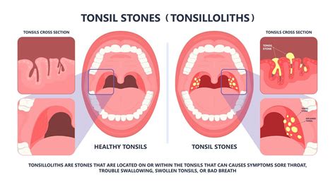 Tonsil Stones – All You Need To Know - London ENT