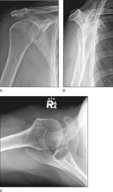 2 Glenoid Fracture Musculoskeletal Key