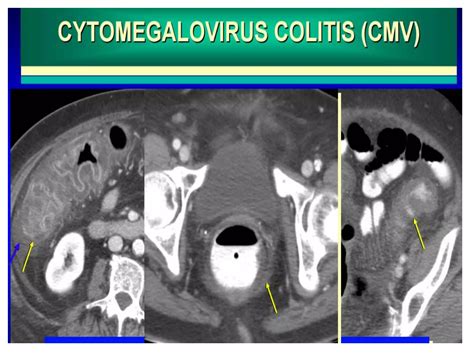 Presentation1 Radiological Imaging Of Colitis Pptx