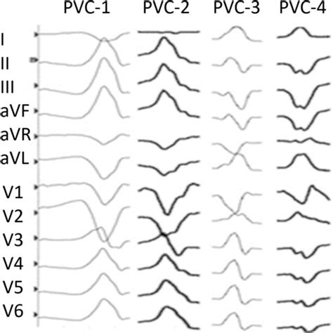 Four Different Pvc Morphologies Were Observed In The Mapping Download