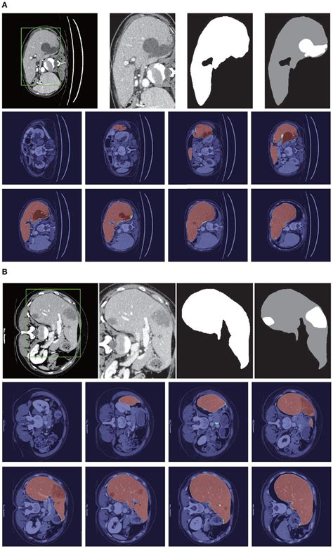 Liver Segmentation Results Based On Ra Unet Ii A From The Lits Download Scientific Diagram