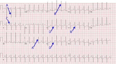 Clinmed Exam 5 Pulmonary Pe And Htn Flashcards Quizlet