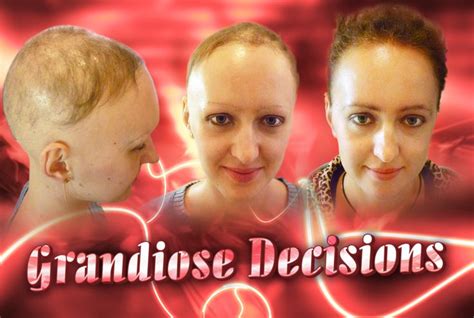 Women Hair Loss Alopecia Areata Alopecia Totalis Alopecia Universalis And Androgenic Alopecia