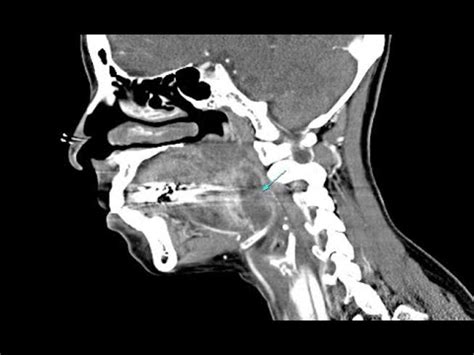 Peritonsillar Abscess Iandd Youtube