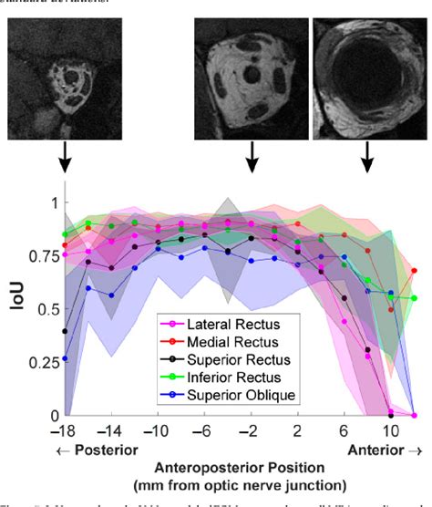 Figure 7 From Deep Learning Based Segmentation Of Extraocular Muscles From Magnetic Resonance
