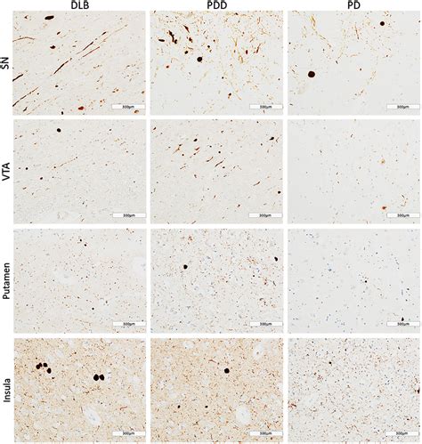 α‐synuclein Pathology Distribution Photomicrographs Of α‐synuclein Download Scientific Diagram