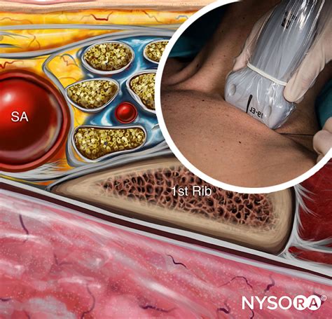 Supraclavicular Block Upper Extremity Blocks Supraclavicular Nerve