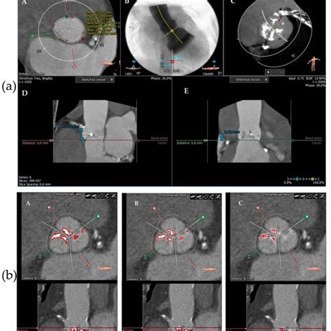 Hemodynamic Measurements And Calculation Of The Aortic Regurgitation Download Scientific