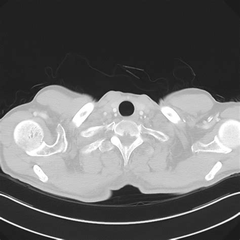 Apical Pleural Calcification Radiopaedia 46141 50499 Axial Lung Window Nc Commons