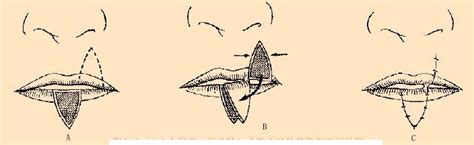 14交唇皮瓣修复鳞状细胞癌扩大切除后下唇缺损（图2 6 14 1～图2 6 14 14） 皮瓣移植实例 医学