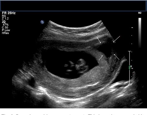 Retroplacental Bleeding