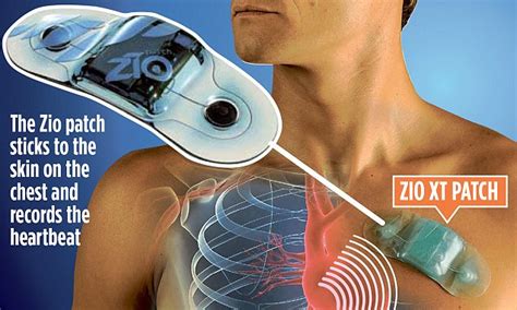 Zio Patch Cardiac Monitoring Downwup