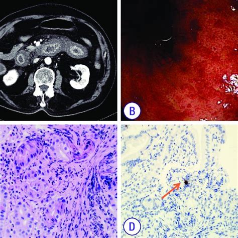 Abdominal Computed Tomography Revealed Diffuse Edematous Thickening Of