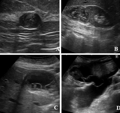 A Breast Us Heterogeneous Hypoechoic Solid Lesion With Acoustically